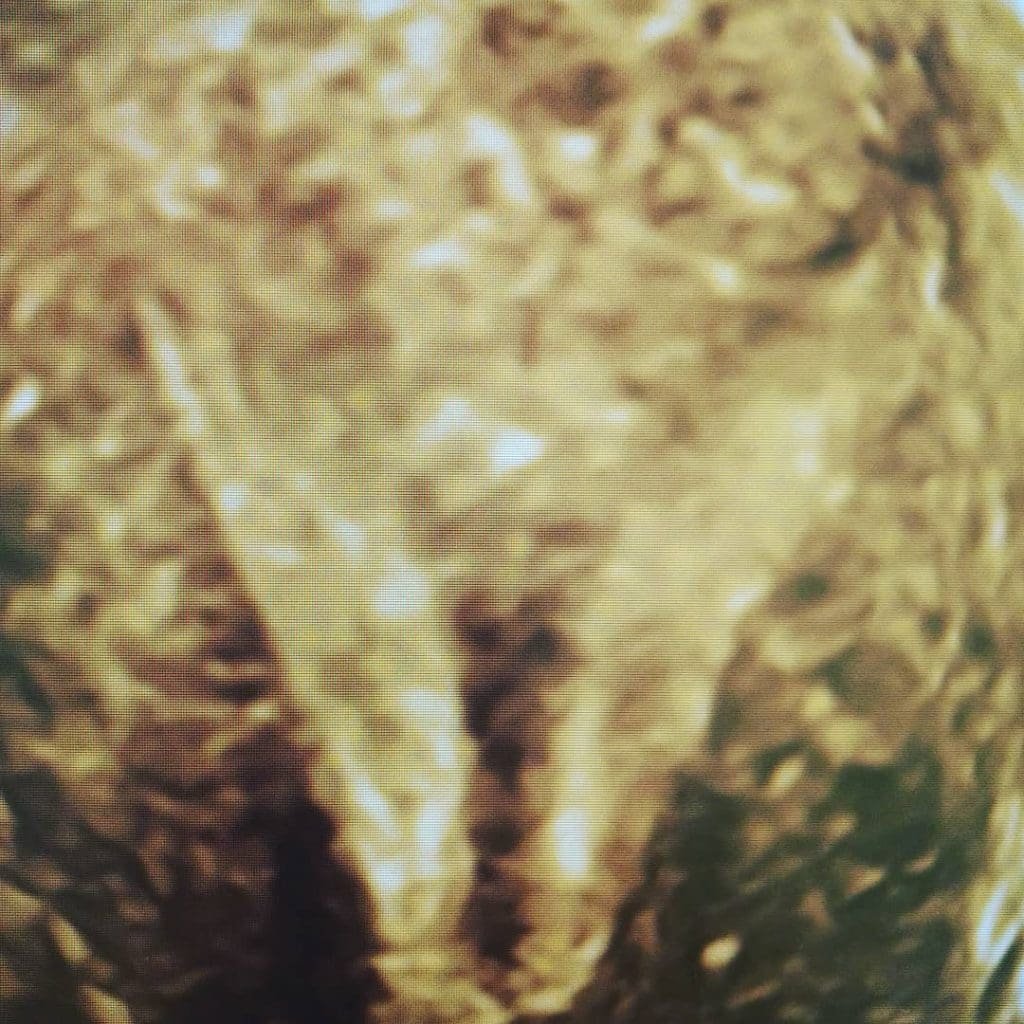 A rare condition - didelphys | The Conception Plan